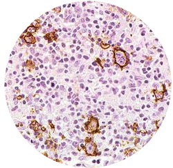 JDW Pathology HPV - JDW Pathology